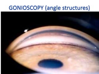 Glaucoma revision | PPT