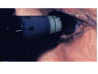 Glaucoma revision | PPT