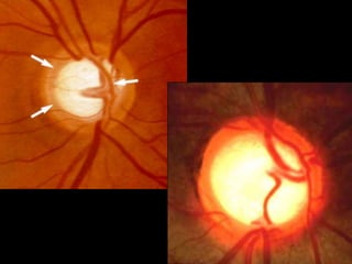 Glaucoma revision | PPT