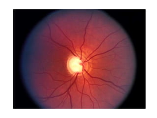 Glaucoma revision | PPT