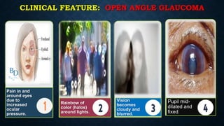 Glaucoma slides | PPTX