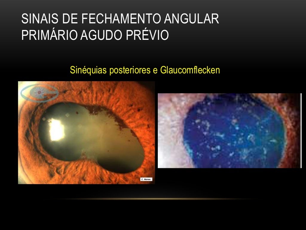 Glaucoma Agudo de ângulo fechado - Acute Angle-Closure Glaucoma