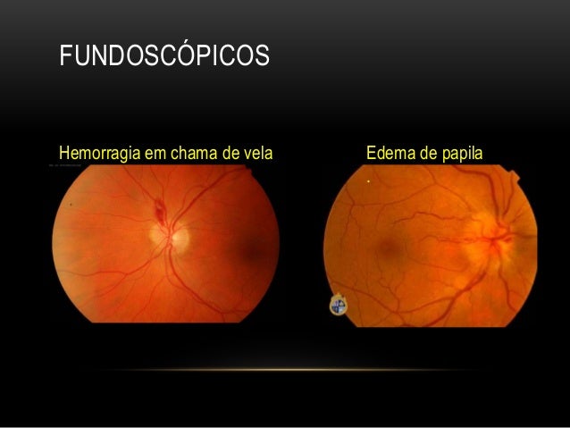 Glaucoma Agudo de ângulo fechado - Acute Angle-Closure Glaucoma