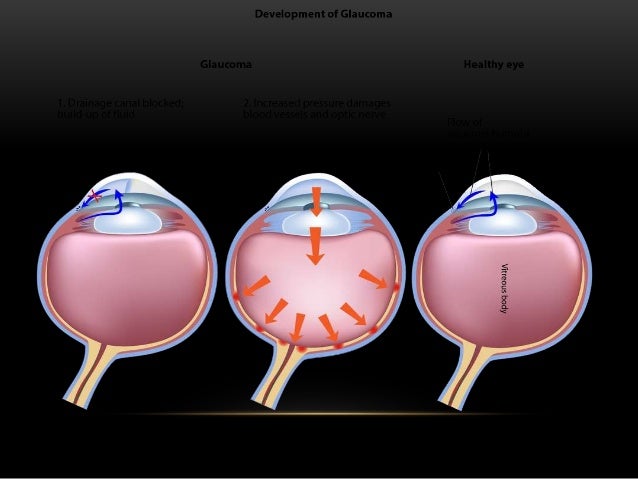 Glaucoma Agudo de ângulo fechado - Acute Angle-Closure Glaucoma