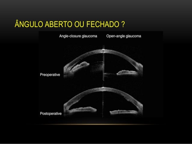 Glaucoma Agudo de ângulo fechado - Acute Angle-Closure Glaucoma