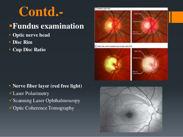 Glaucoma suspects and normal pressure glaucoma