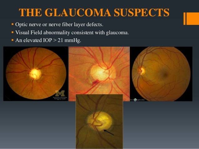 Glaucoma suspects and normal pressure glaucoma