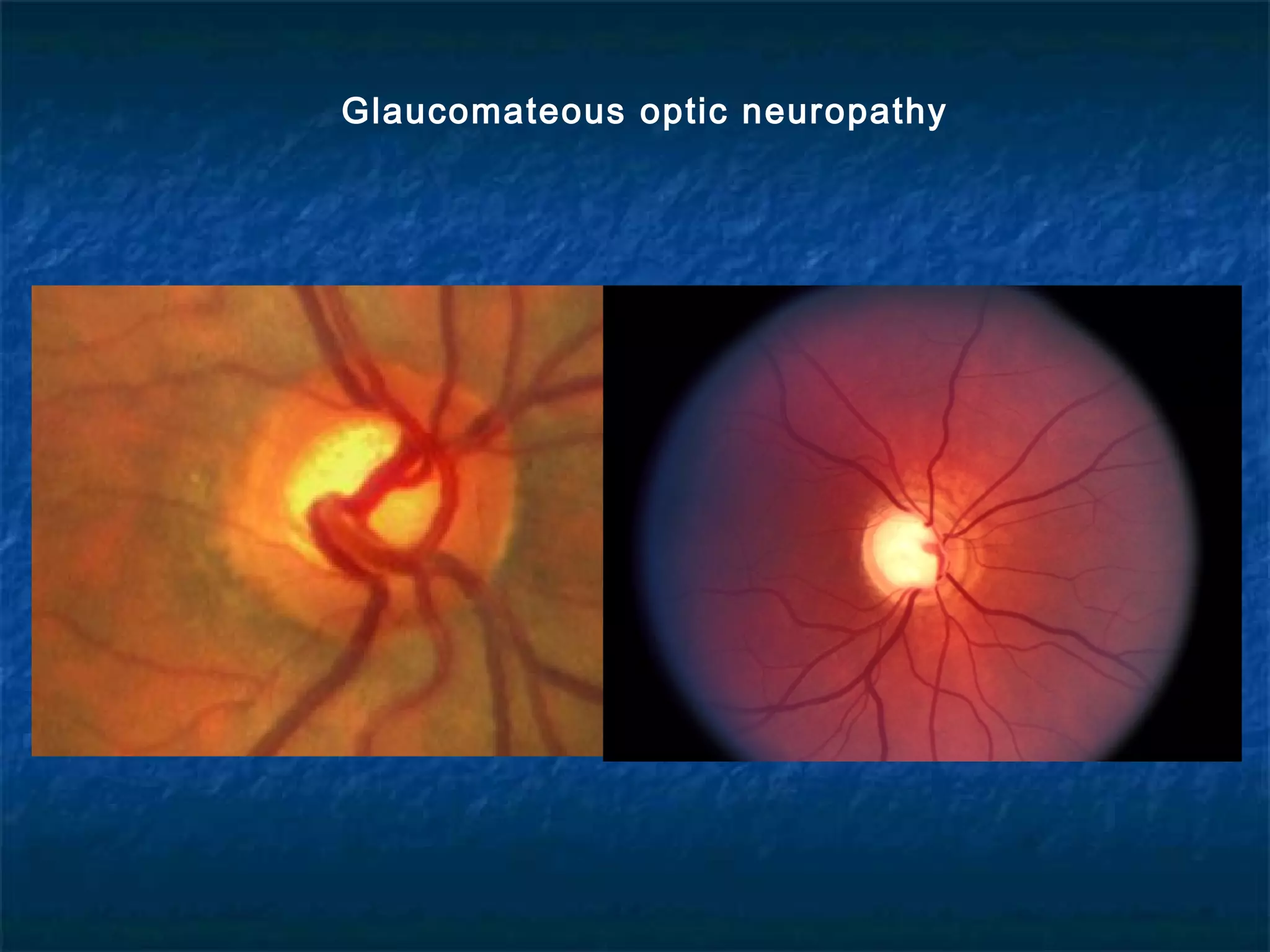 Glaucoma & target iop | PPT