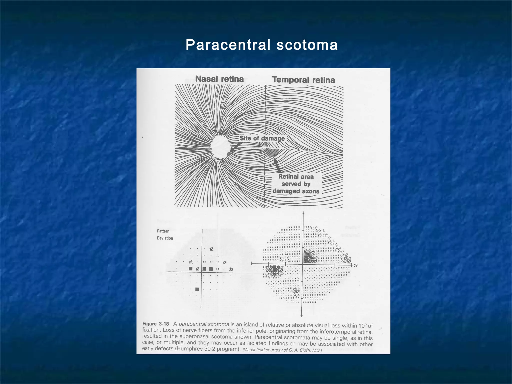 Glaucoma & target iop | PPT