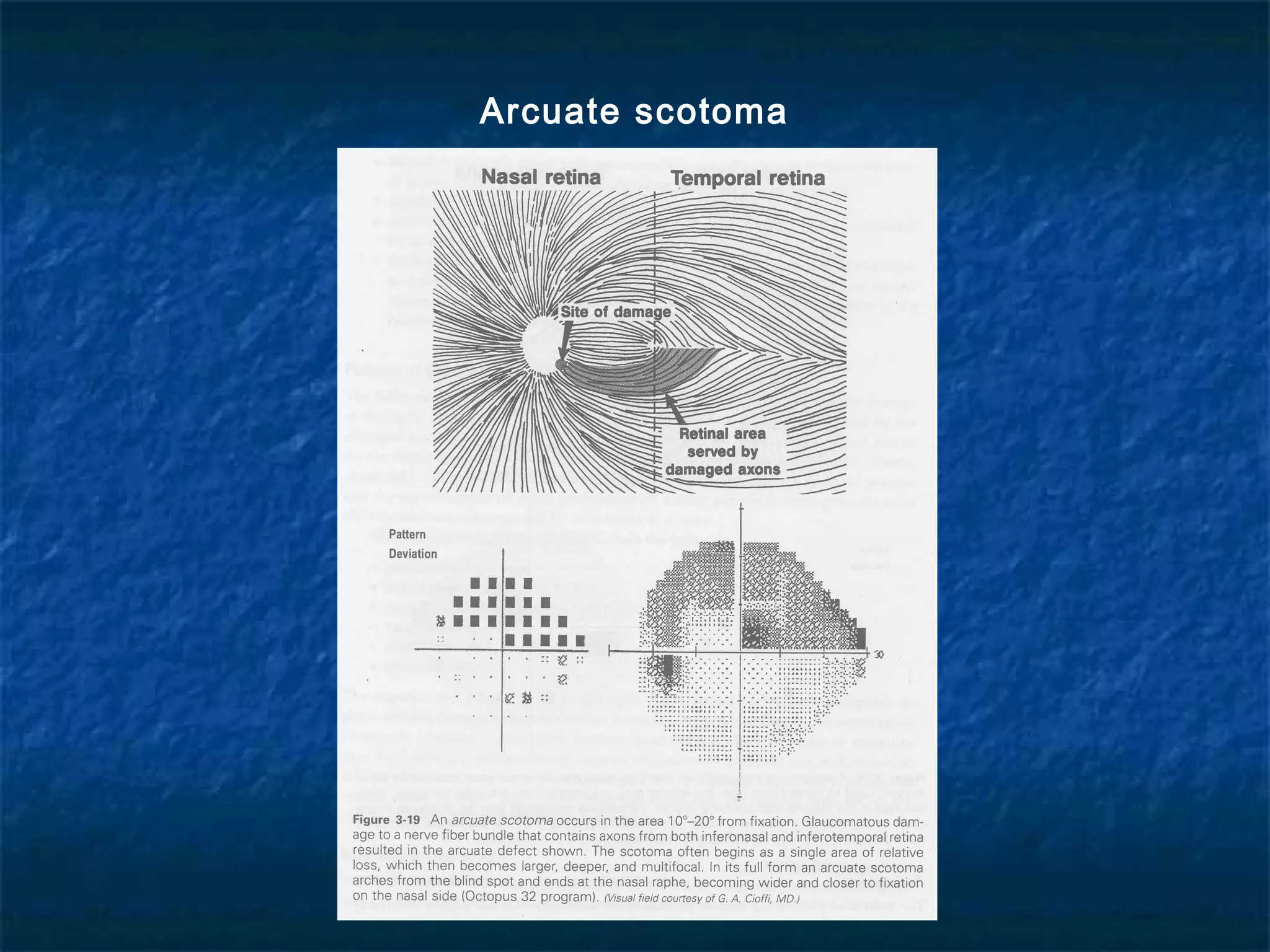 Glaucoma & target iop | PPT