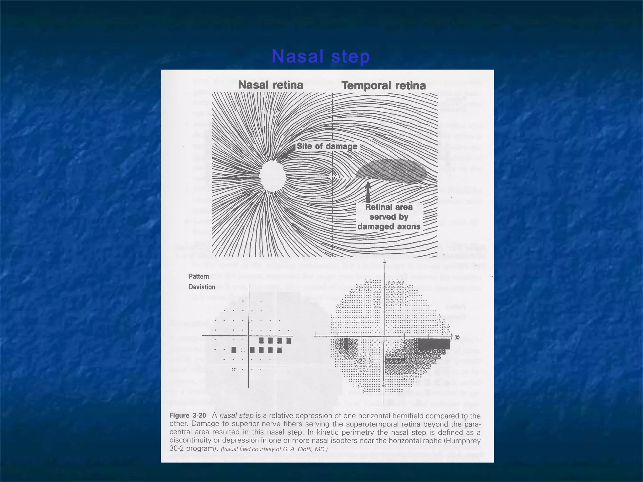 Glaucoma & target iop | PPT