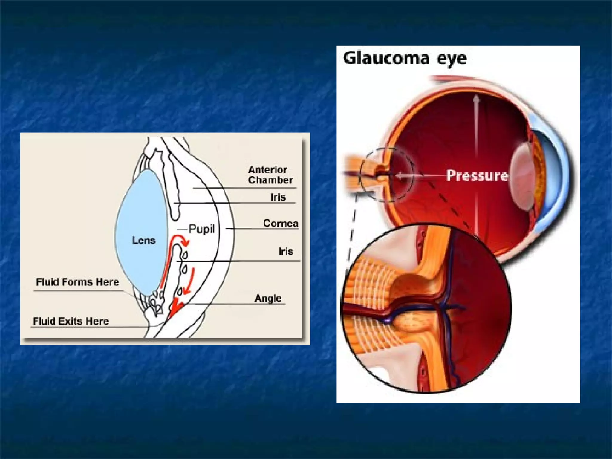 Glaucoma & target iop | PPT