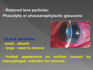 Glaucoma tips in vitrectomy | PPTX | Eye and Vision Conditions ...