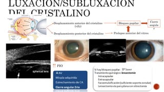 Glaucoma traumático | PPTX