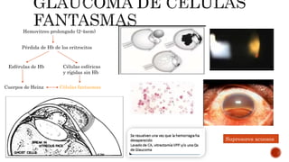 Glaucoma traumático | PPTX