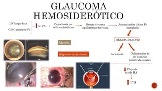 Glaucoma traumático | PPTX