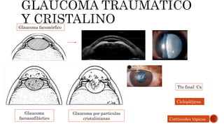 Glaucoma traumático | PPTX