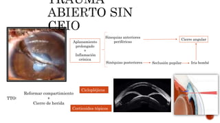 Glaucoma traumático | PPTX