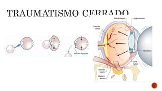 Glaucoma traumático | PPTX