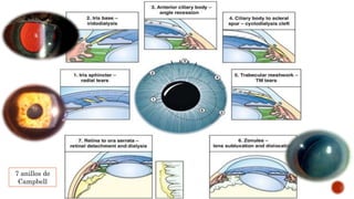 Glaucoma traumático | PPTX