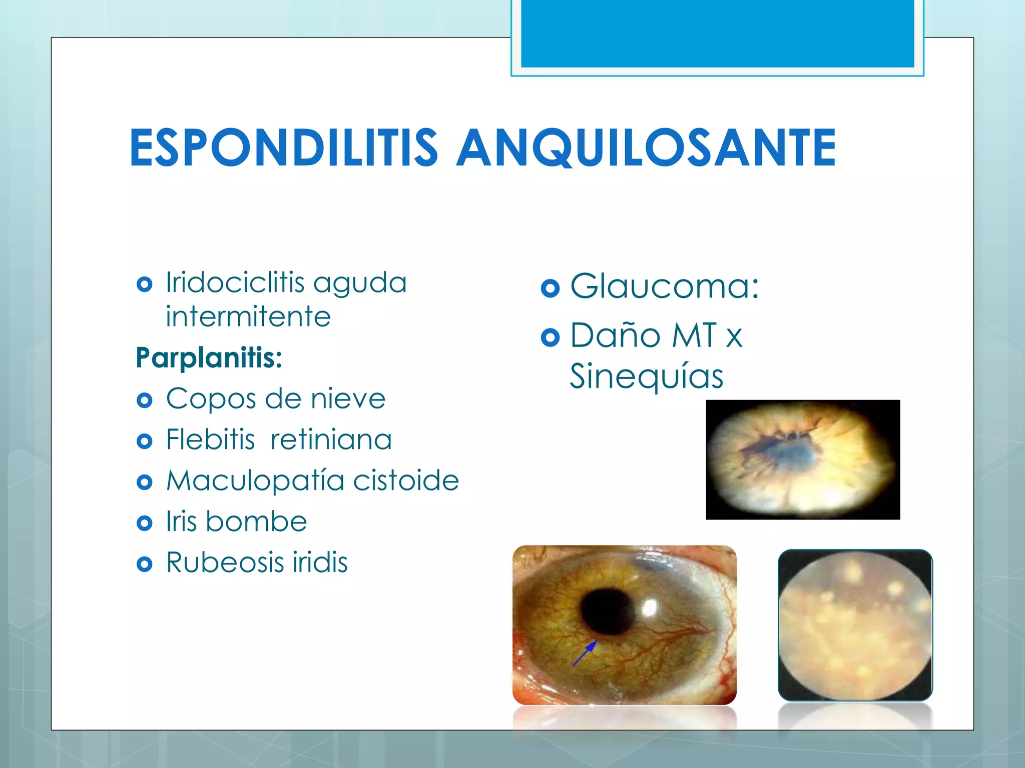 Glaucoma traumatico e inflamatorio ppt | PPTX