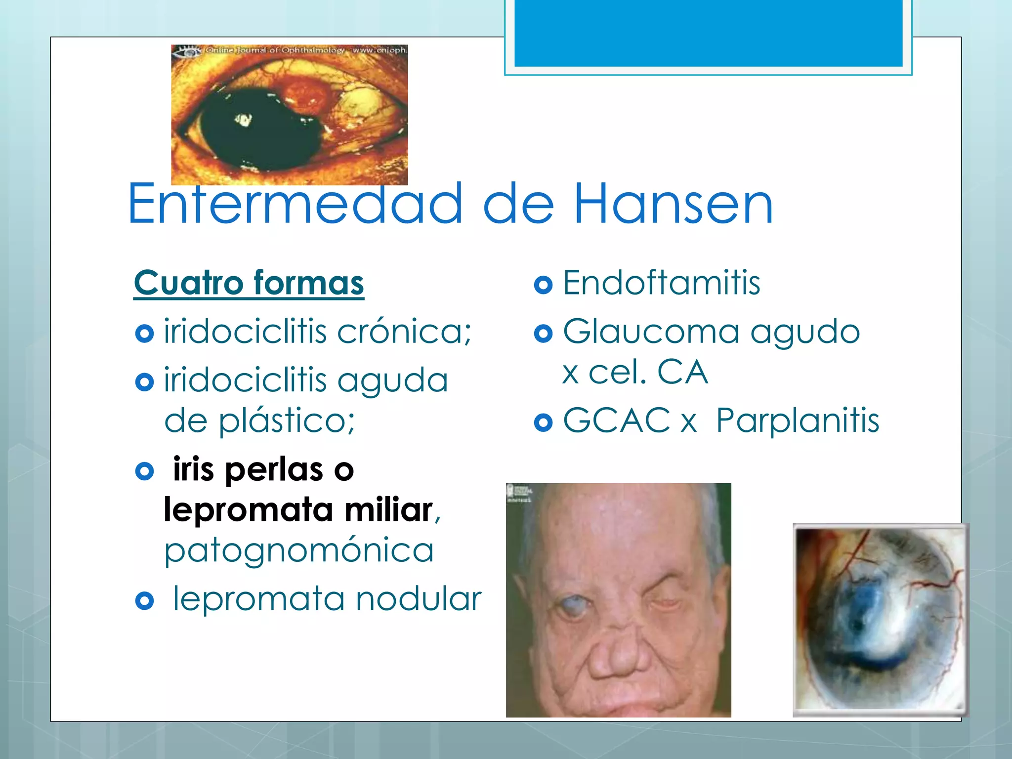 Glaucoma traumatico e inflamatorio ppt | PPTX
