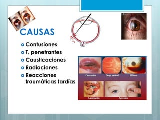 Glaucoma traumatico e inflamatorio ppt | PPTX