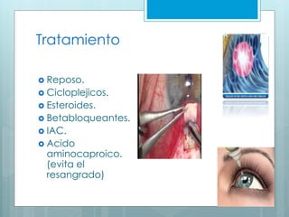 Glaucoma traumatico e inflamatorio ppt | PPTX