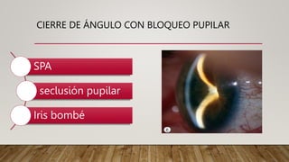 Glaucoma traumático, inflamatorio y asociado a esteroides jean (1).pptx
