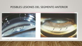 Glaucoma traumático, inflamatorio y asociado a esteroides jean (1).pptx