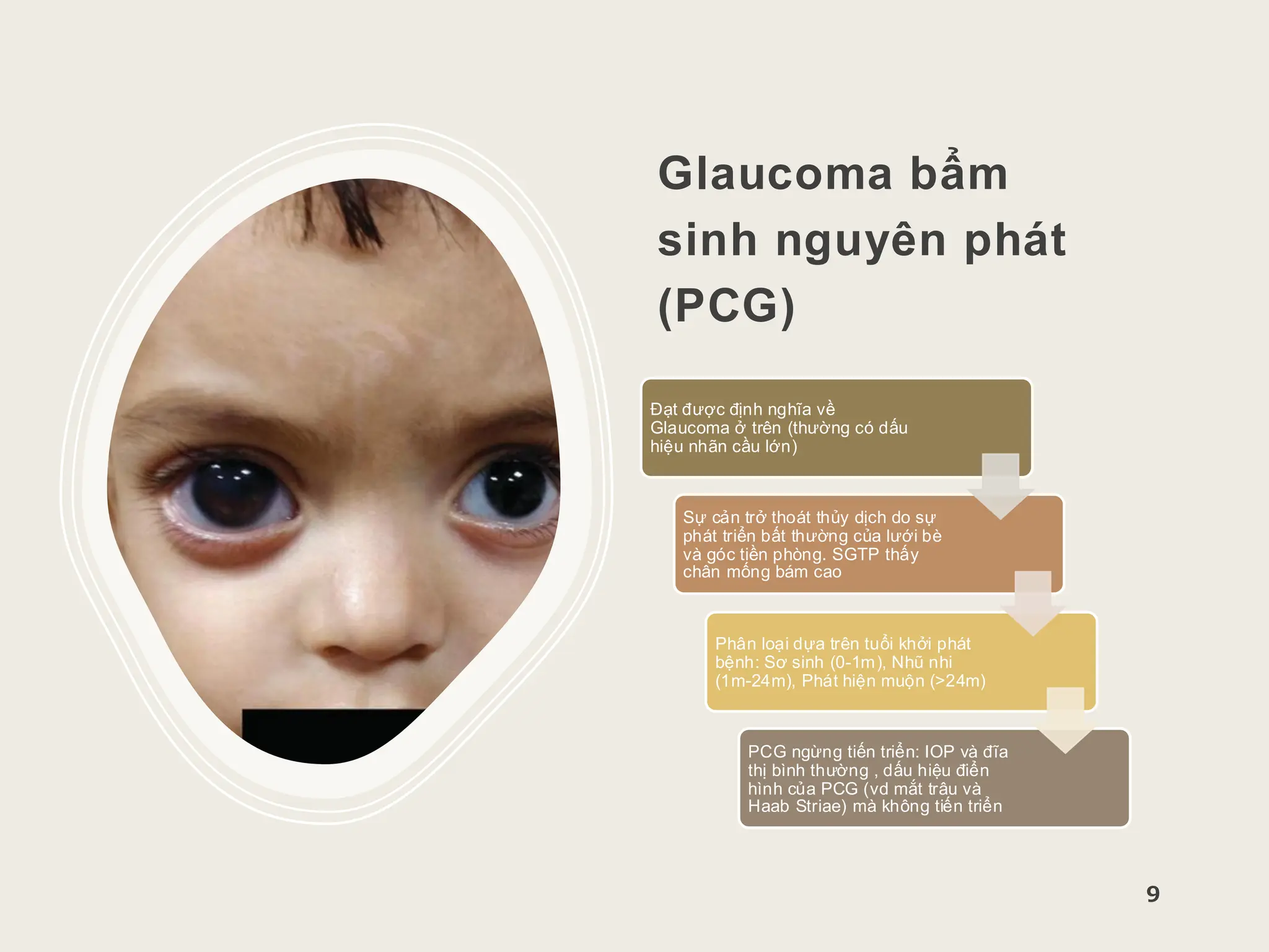 Glaucoma trẻ em: Phát hiện, phân loại và can thiệp.pdf