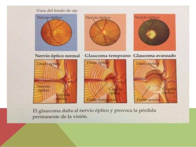 Glaucoma y sus sintomas