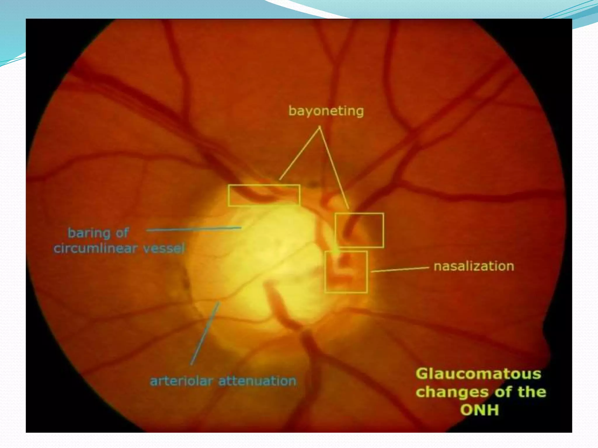 GLAUCOMA | PPT
