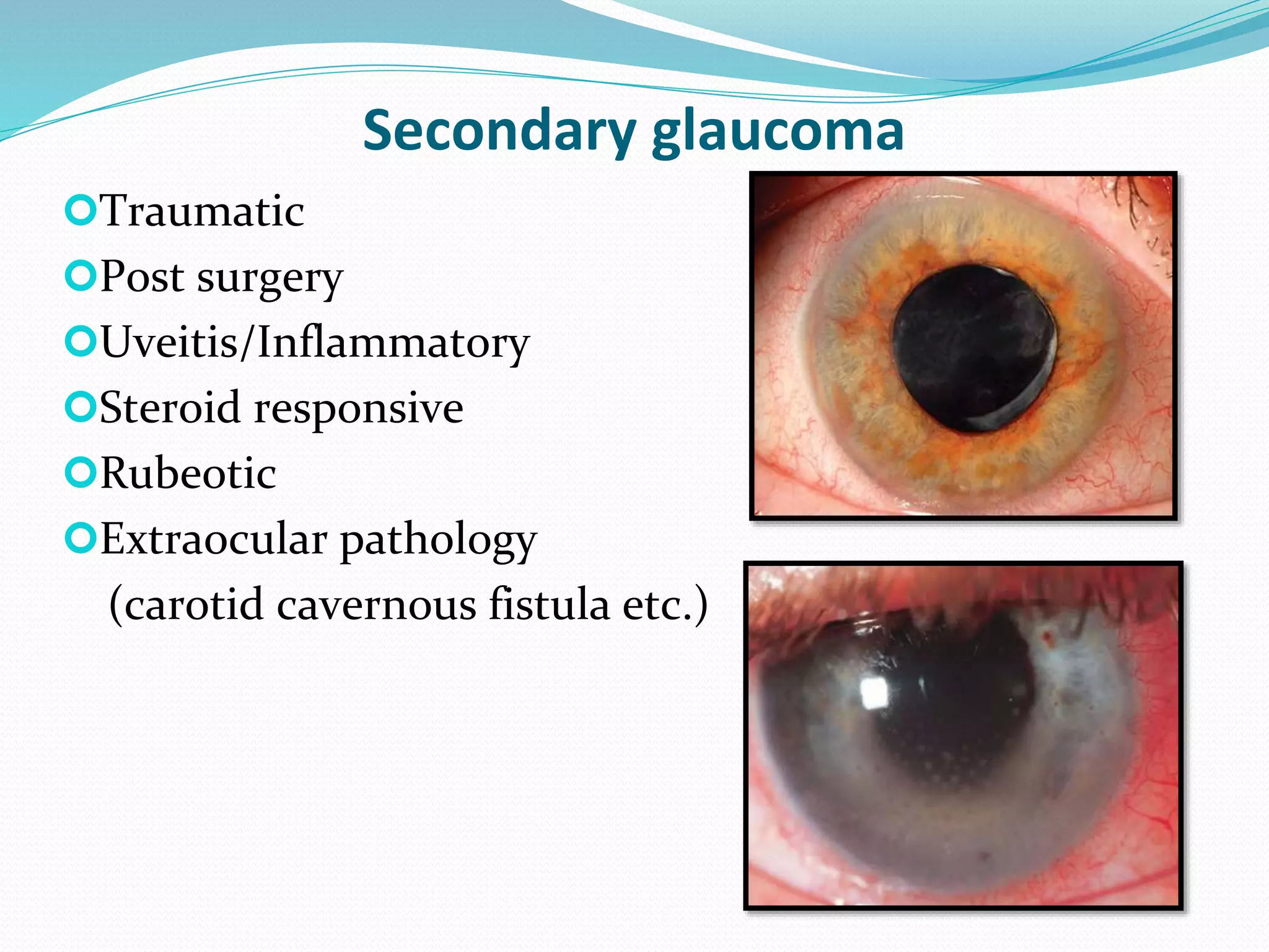 GLAUCOMA | PPT