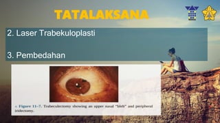 GLAUKOMA.pptx