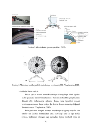 Glaukoma Fakomorfik.pdf