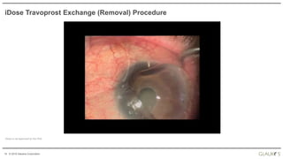 Glaukos january 2018 presentation | PDF | Eye and Vision Conditions ...