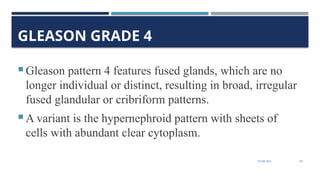 gleason classifaction histopathology and scoring | PPTX