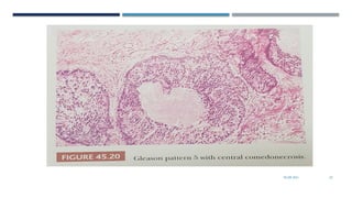 gleason classifaction histopathology and scoring | PPTX