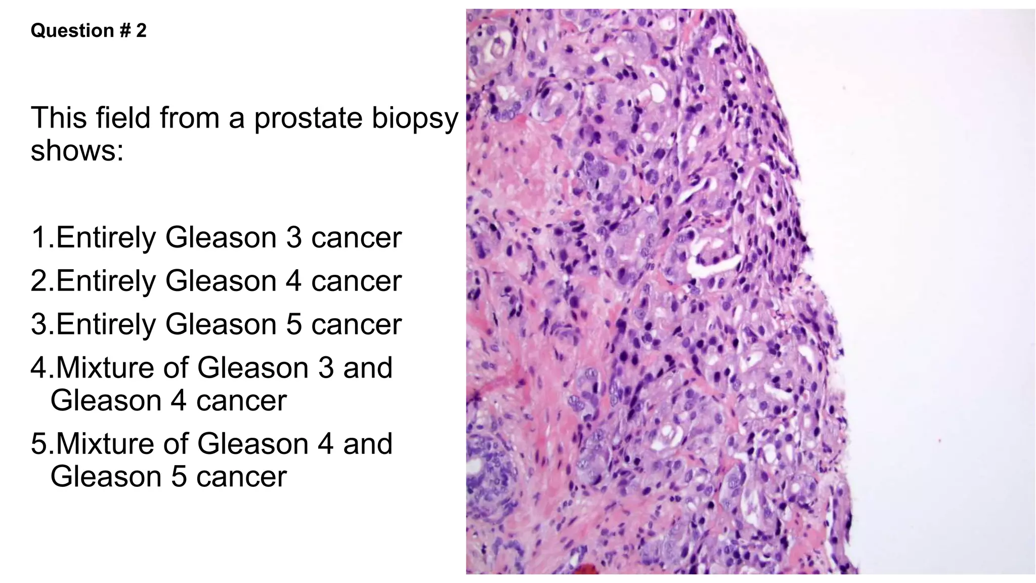 Gleason Grading of Prostate Cancer.pptx