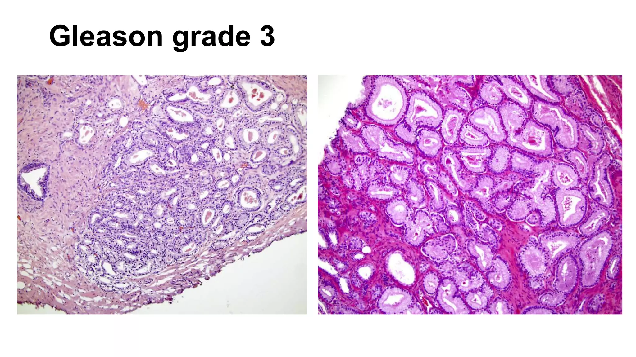 Gleason Grading of Prostate Cancer.pptx