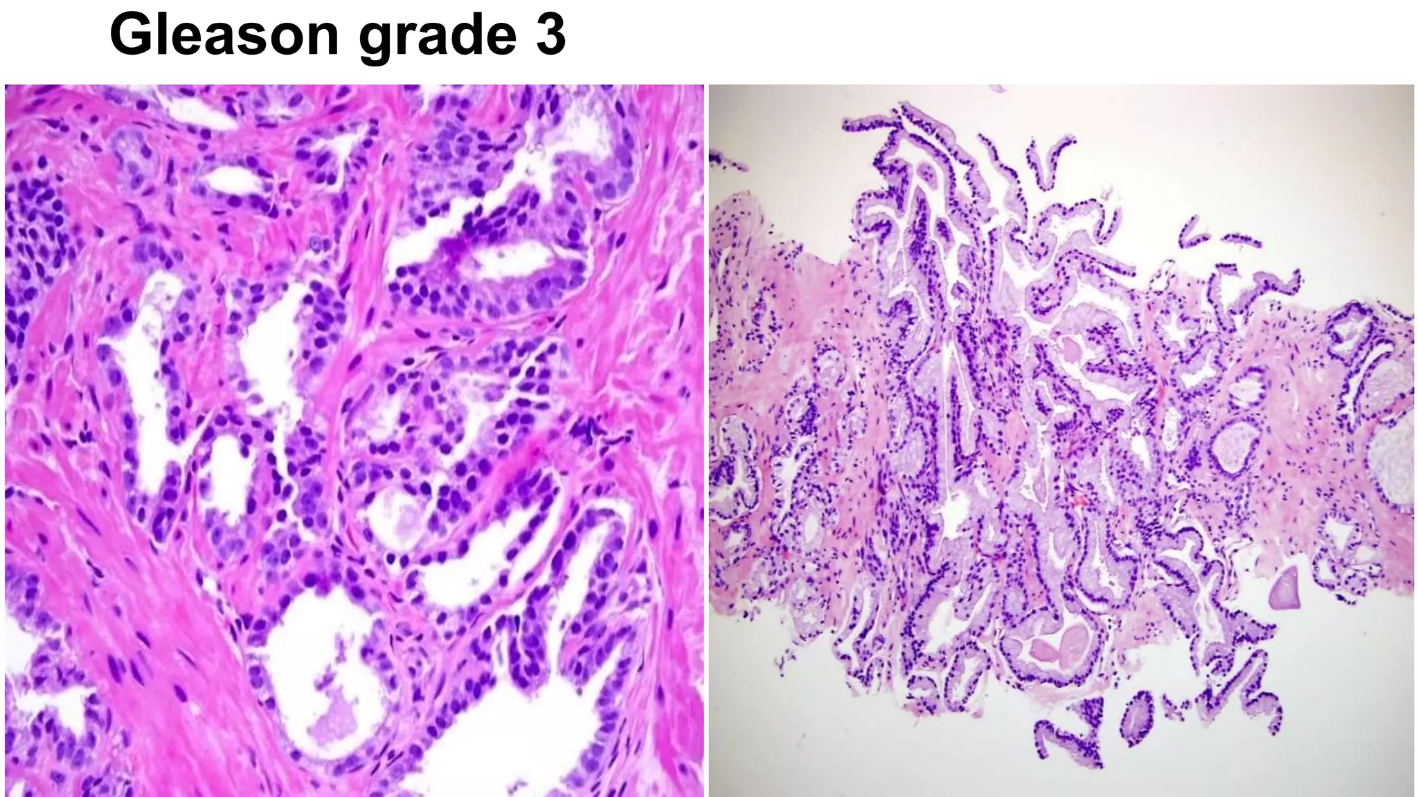 Gleason Grading of Prostate Cancer.pptx