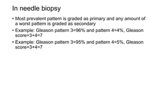Gleason Grading of Prostate Cancer.pptx