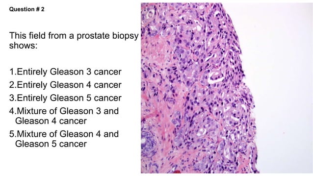 Gleason Grading of Prostate Cancer.pptx