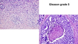Gleason Grading of Prostate Cancer.pptx
