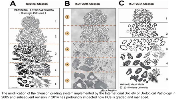 Gleason Grading of Prostate Cancer.pptx