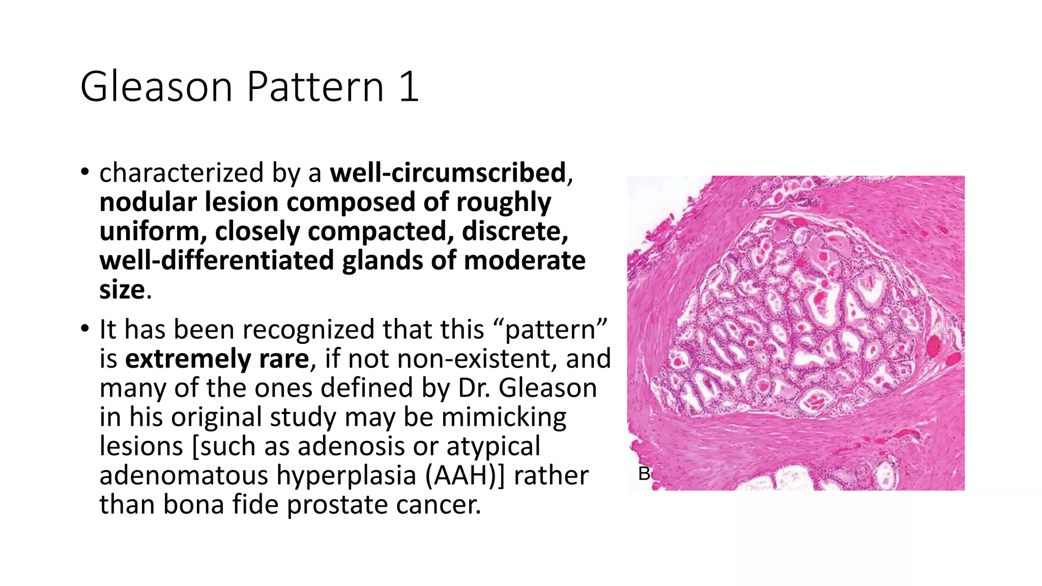 Gleason grading system | PPTX
