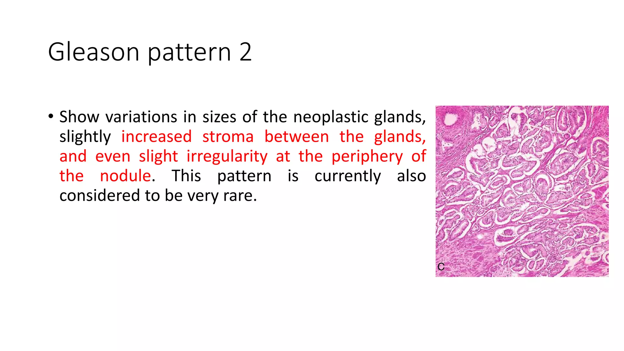 Gleason grading system | PPTX