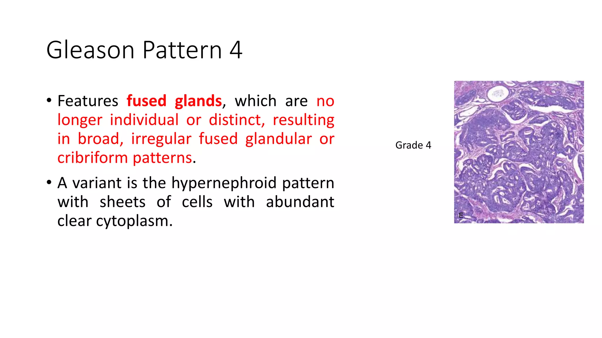 Gleason grading system | PPTX