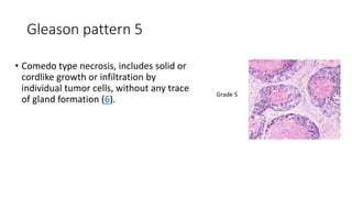 Gleason grading system | PPTX